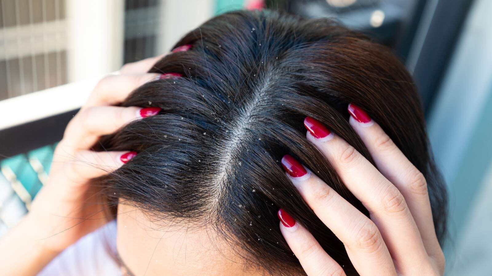 Caspa: cómo eliminarla del cabello y cuáles son sus causas - La Tercera