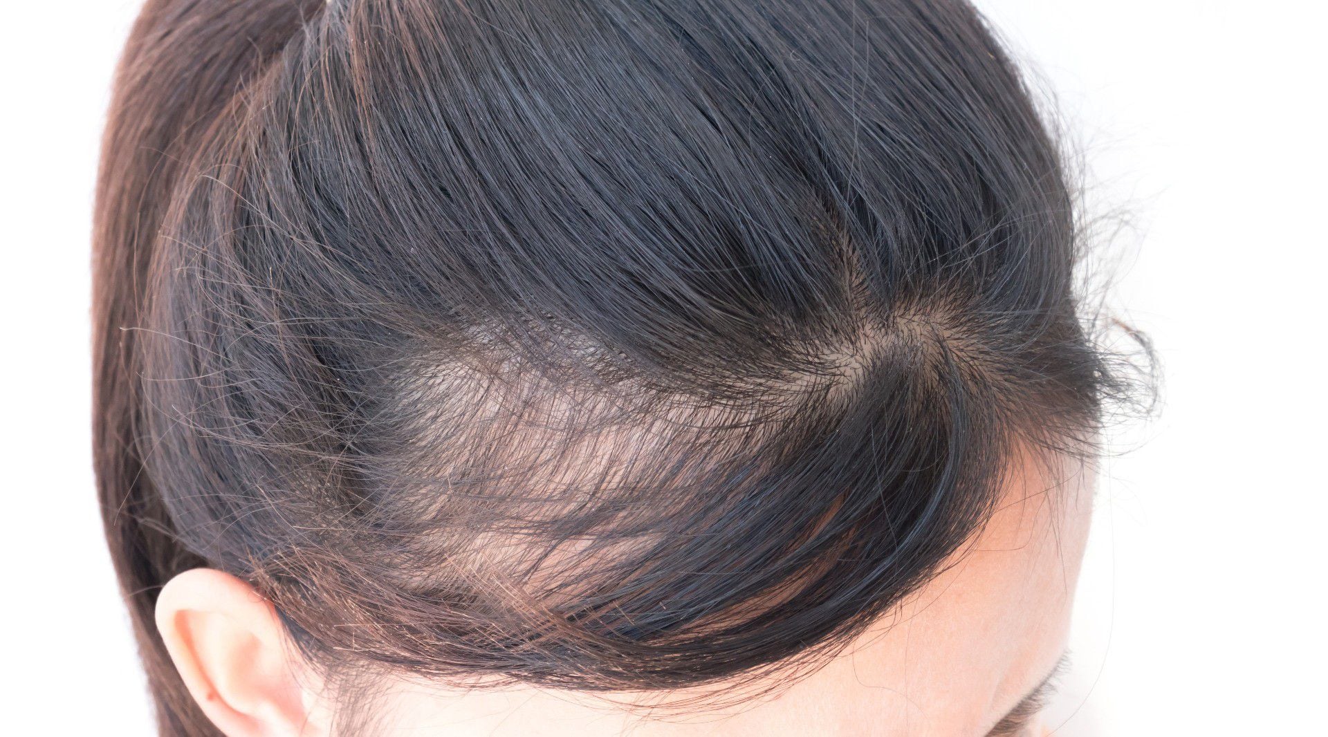 Caída excesiva de pelo: cómo identificarla y qué hacer - La Tercera