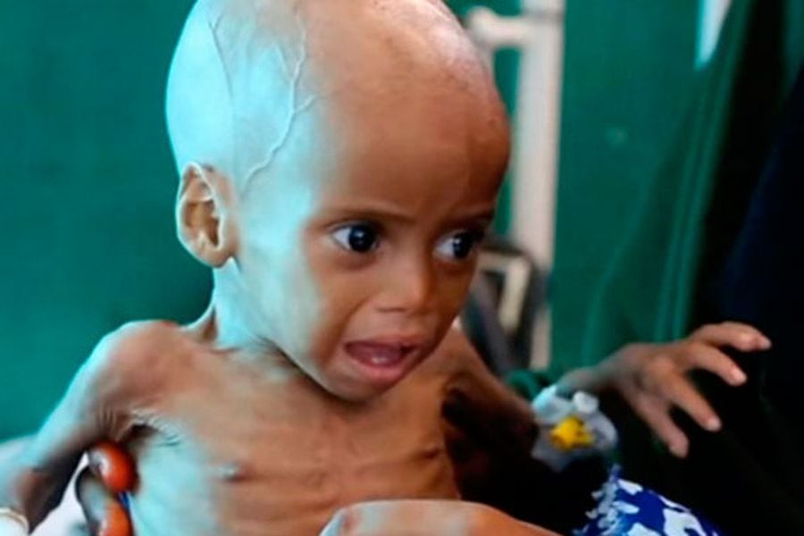 Exclusivo de la BBC: la agonía de los niños desnutridos que no tienen ...