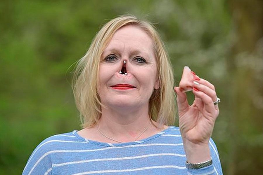 La sorprendente prótesis nasal que se une con imanes y le cambió la ...